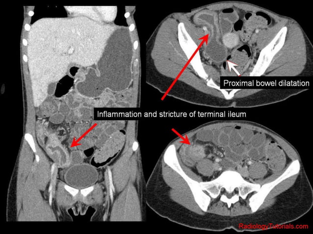 INFLAMMATORY BOWEL DISEASE IMAGING(RADIOLOGY) | PPTX