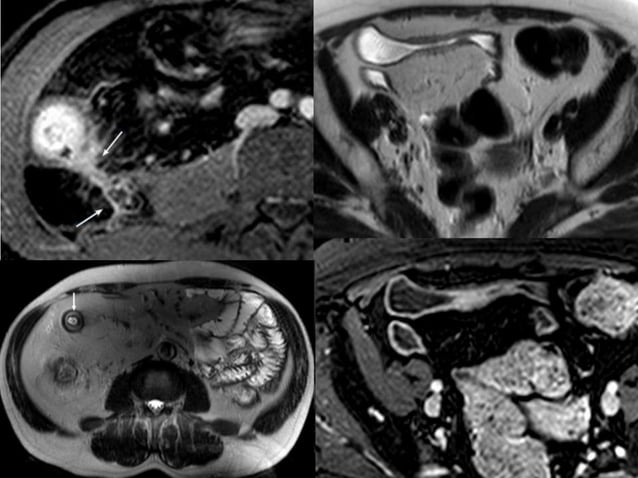 INFLAMMATORY BOWEL DISEASE IMAGING(RADIOLOGY) | PPTX
