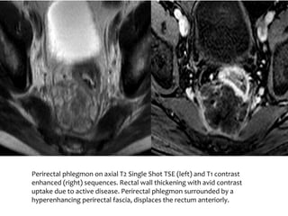INFLAMMATORY BOWEL DISEASE IMAGING(RADIOLOGY) | PPTX