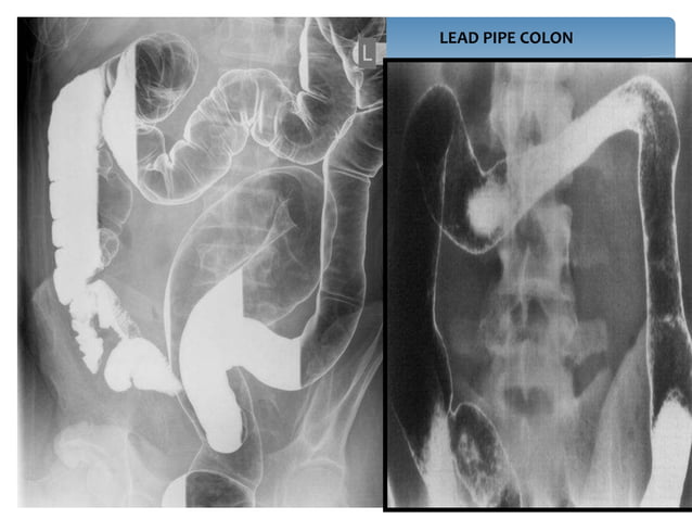 INFLAMMATORY BOWEL DISEASE IMAGING(RADIOLOGY) | PPT