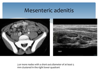 INFLAMMATORY BOWEL DISEASE IMAGING(RADIOLOGY) | PPTX