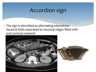 INFLAMMATORY BOWEL DISEASE IMAGING(RADIOLOGY) | PPTX