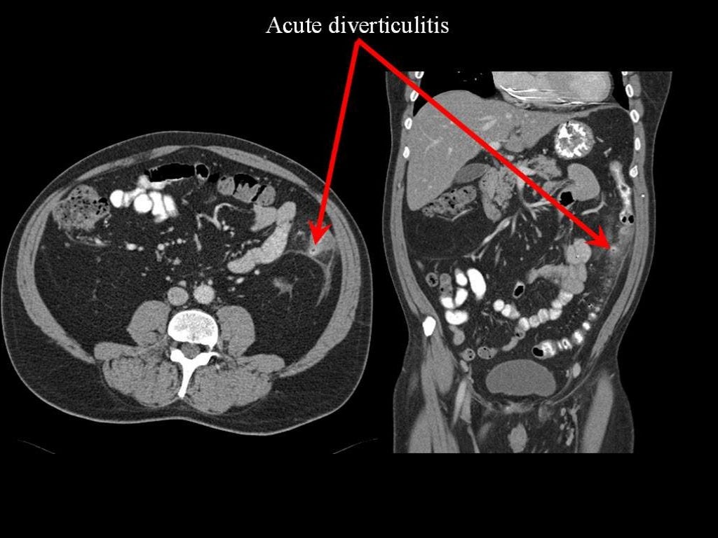 INFLAMMATORY BOWEL DISEASE IMAGING(RADIOLOGY)