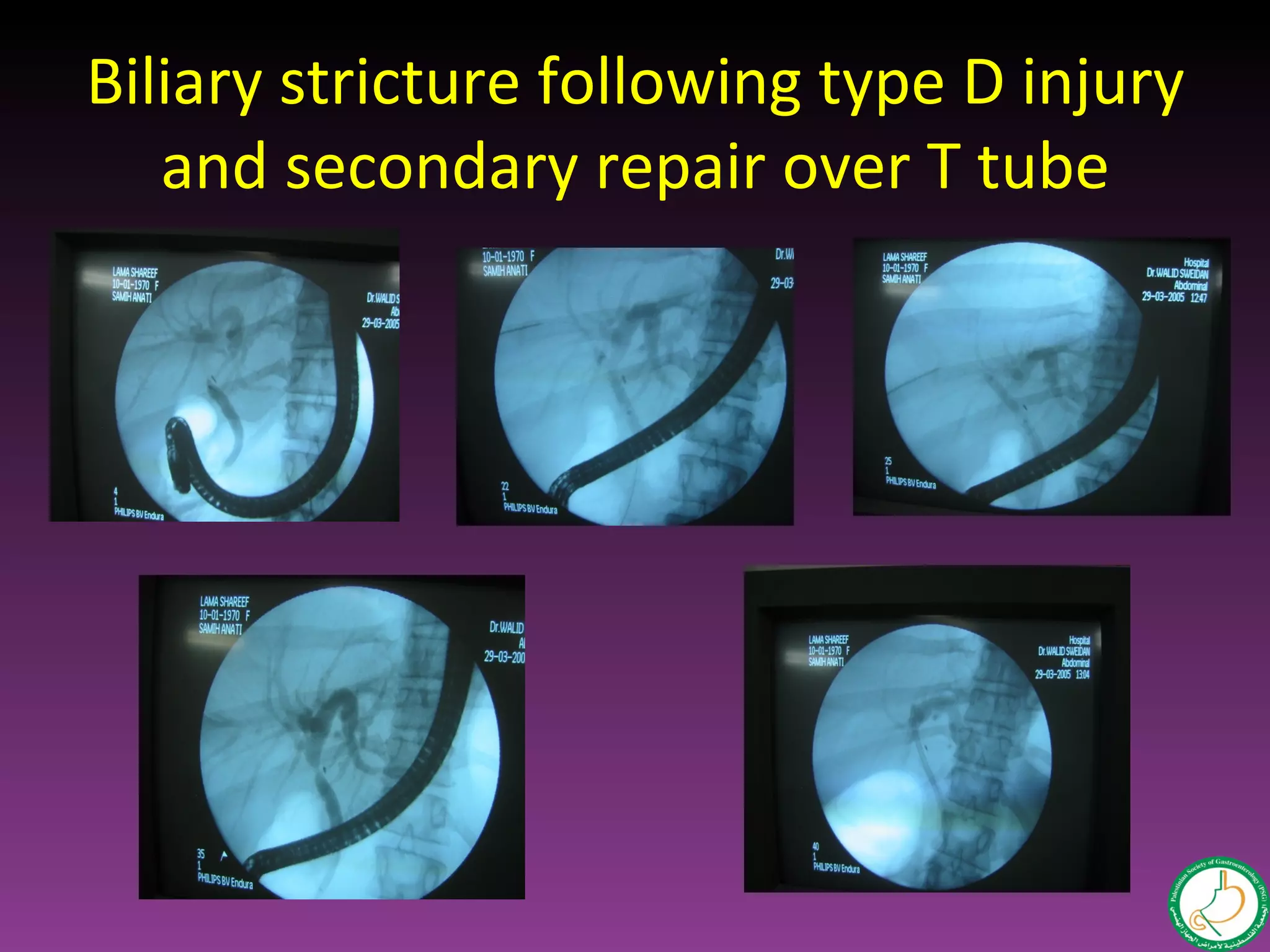 Iatrogenic biliary tract injuries | PPT
