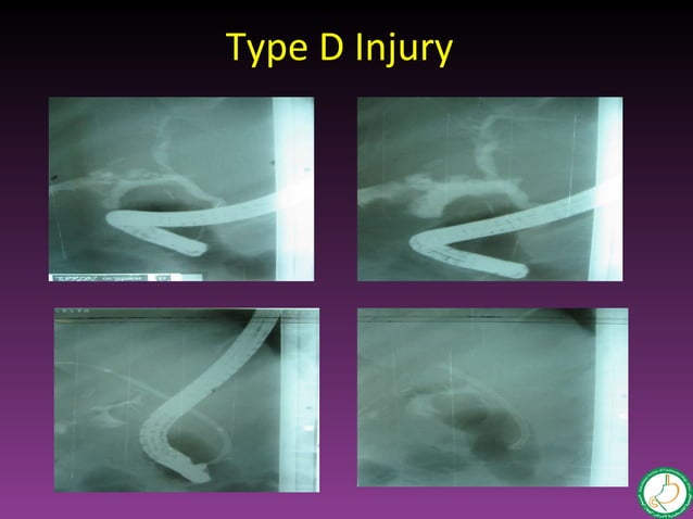 Iatrogenic biliary tract injuries | PPT | Digestive Disorders ...