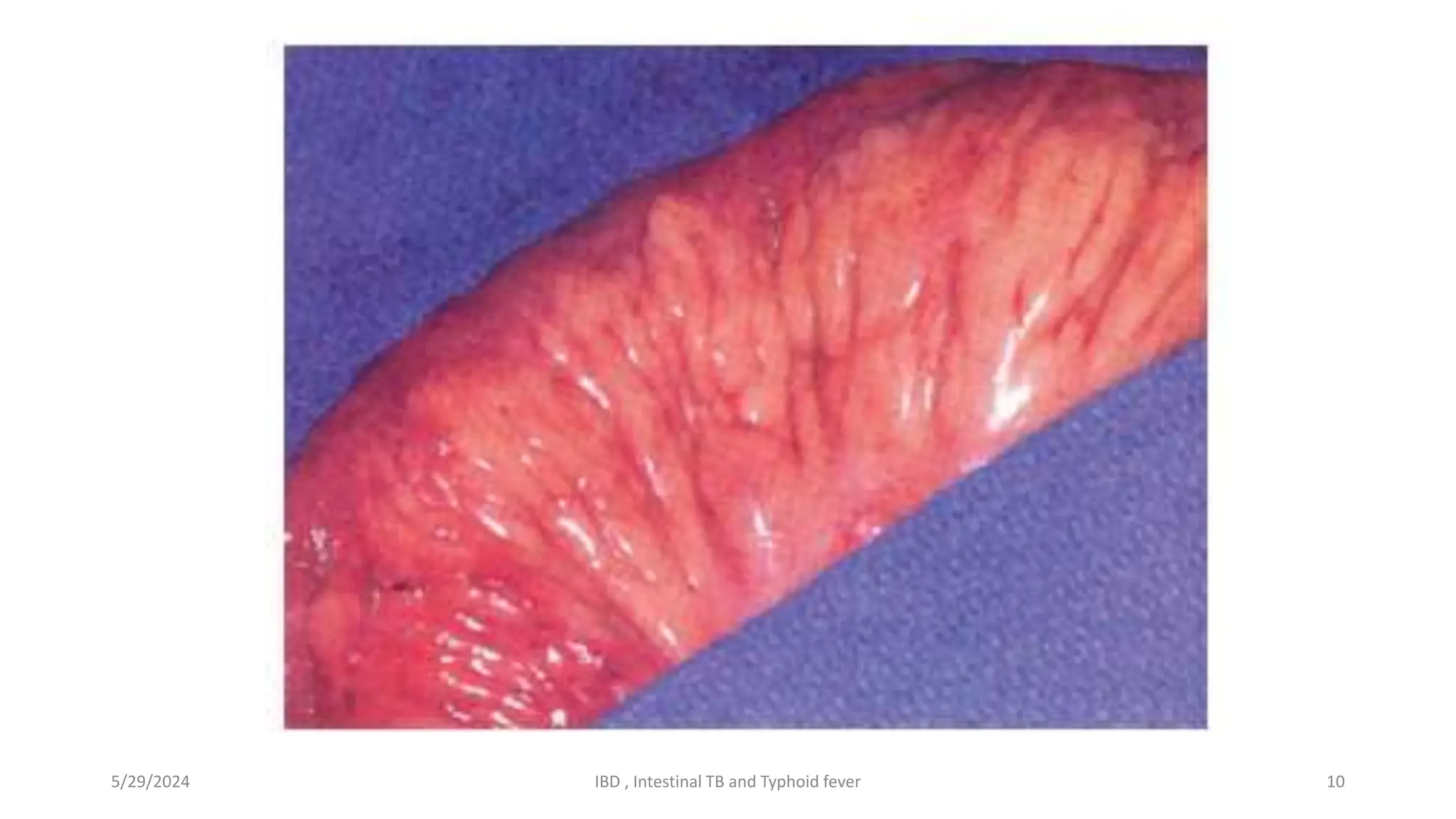IBD, Intestinal TB and Typhoid fever.pptx