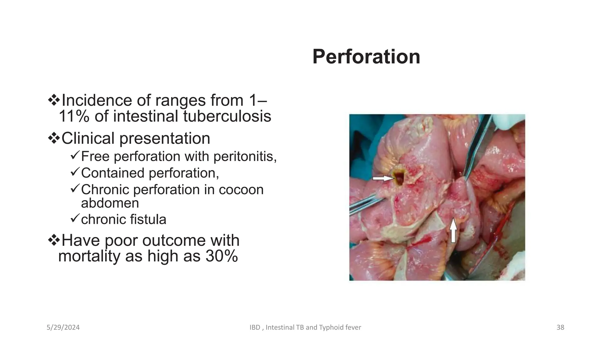 IBD, Intestinal TB and Typhoid fever.pptx