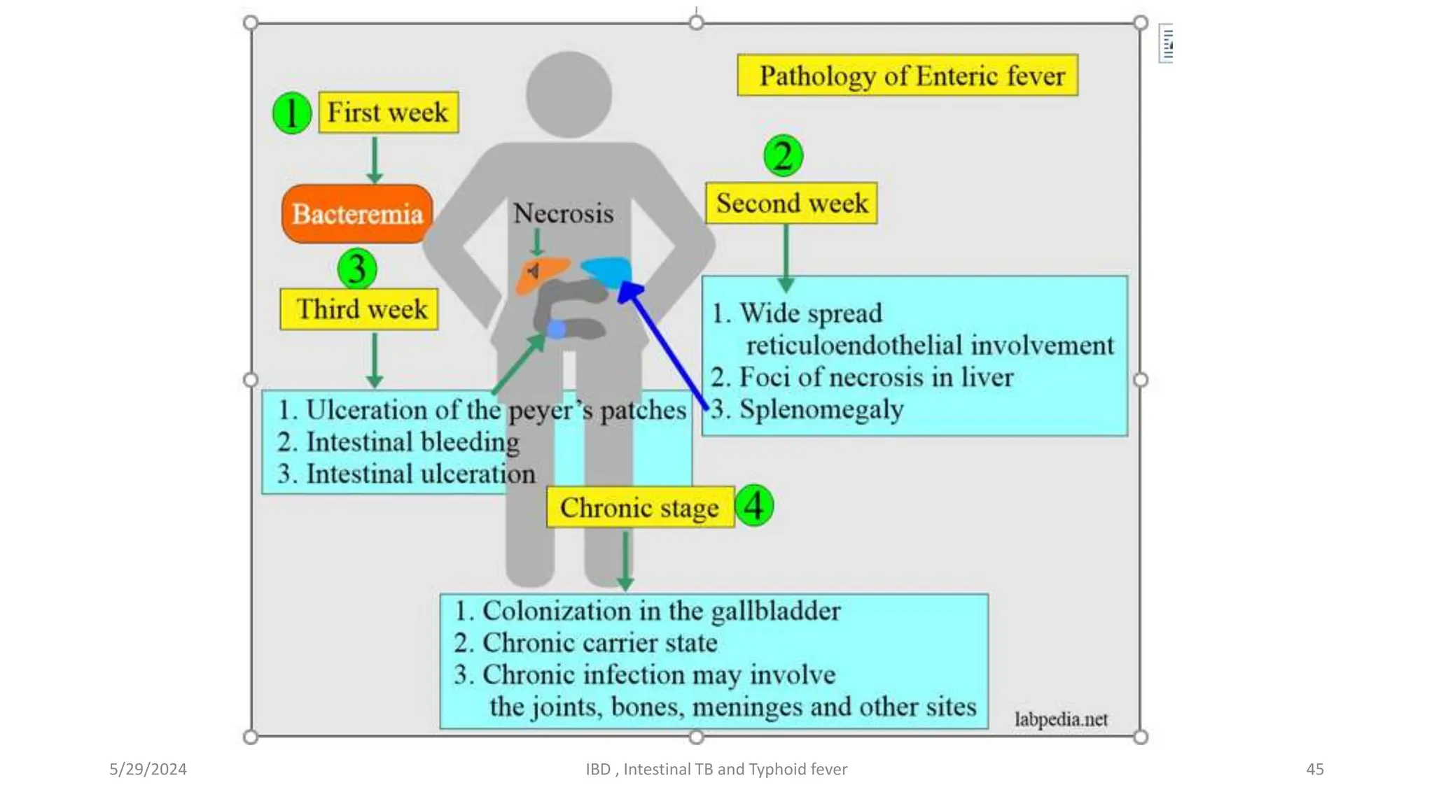 IBD, Intestinal TB and Typhoid fever.pptx