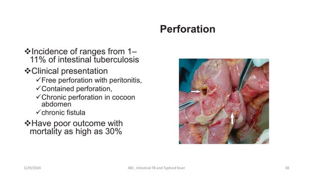 IBD, Intestinal TB and Typhoid fever.pptx
