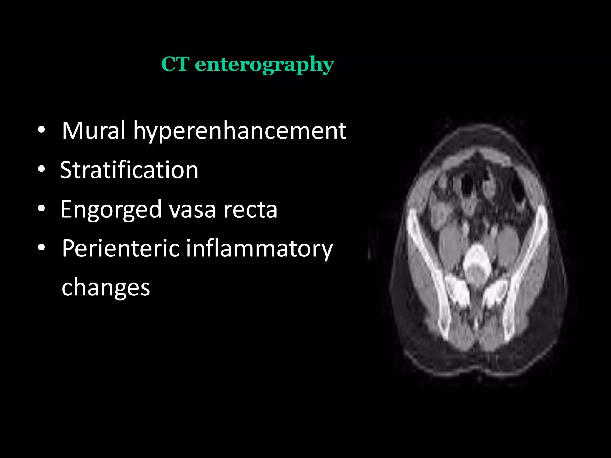 Inflammatory Bowel Diseases | PPTX
