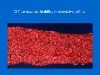 IBD___malabsorption pathology lecture.ppt