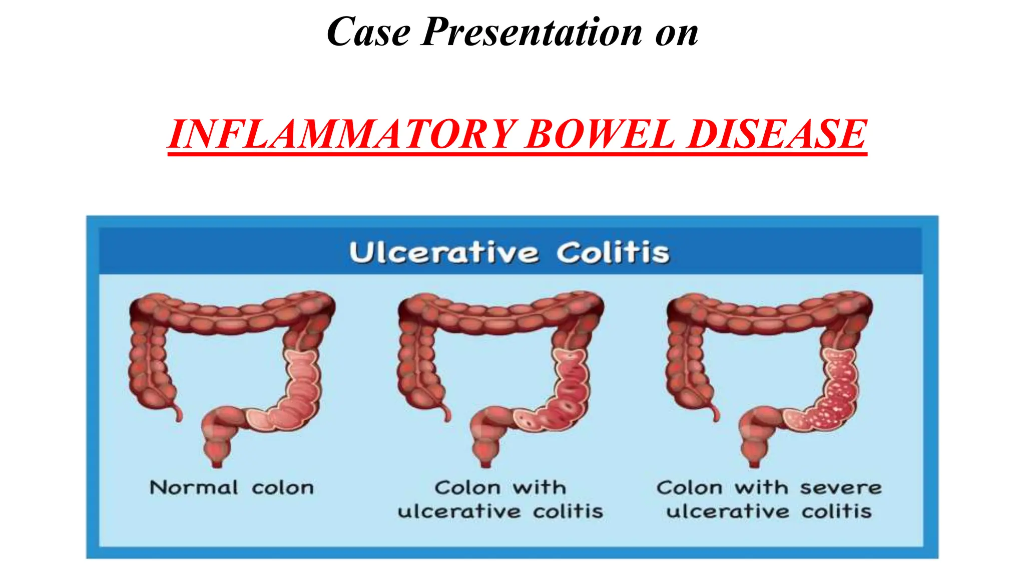 IBD [Ulcerative Colitis] | PPTX