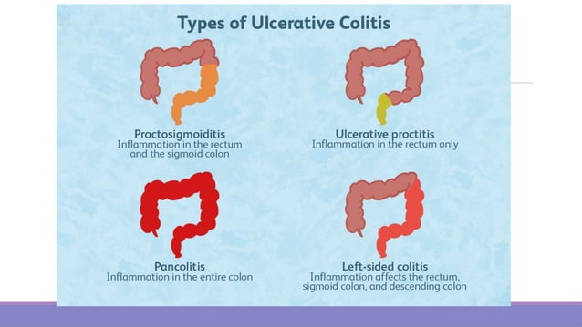 IBD- Inflammatory bowel disease. 2 types - ulcerative colitis and crohn ...