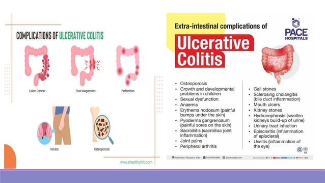 IBD- Inflammatory bowel disease. 2 types - ulcerative colitis and crohn ...