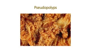 Inflammatory Bowel Disease _RDP | PPTX