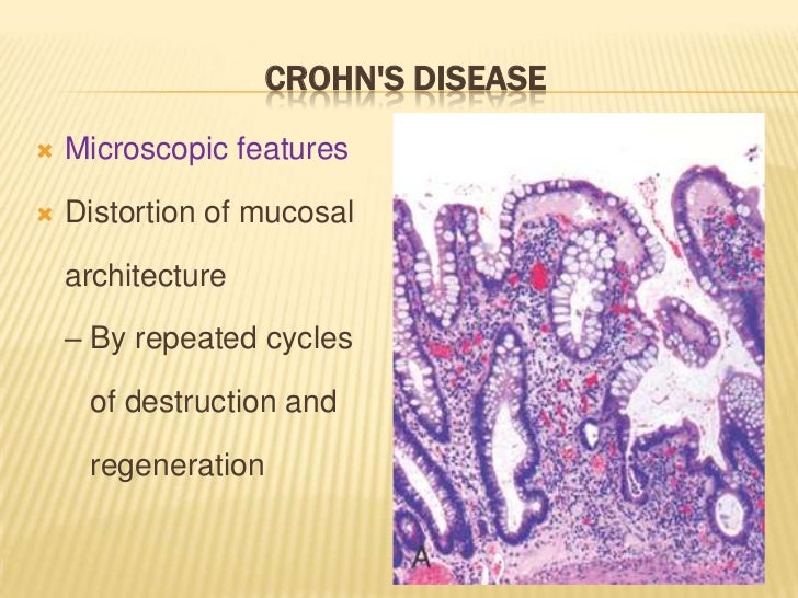 IBD