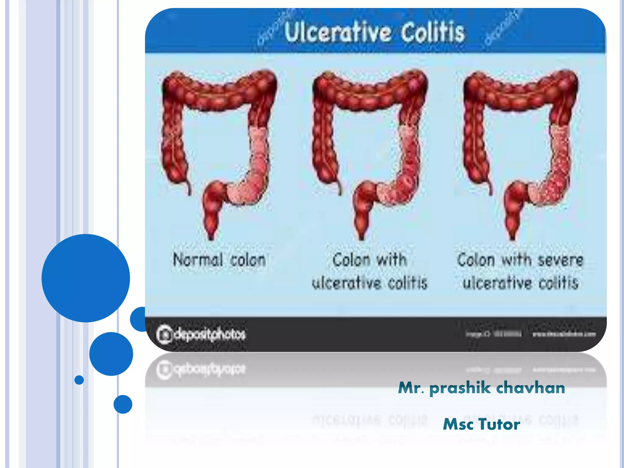 IBD=Ulcerative colitis.pptx