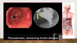 Inflammatory Bowel Disease | PPTX