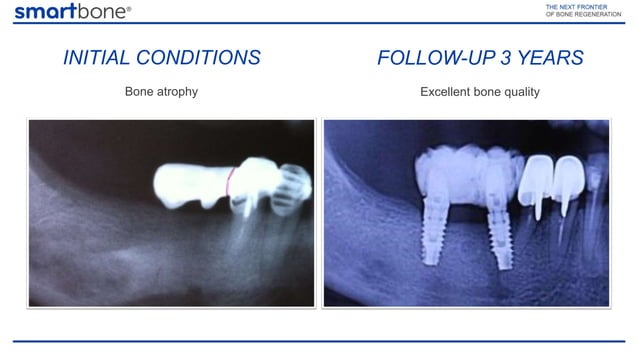 Block technique using SmartBone | PPT