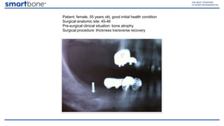 Block technique using SmartBone | PPT