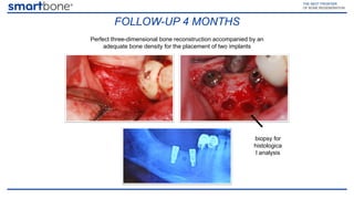 Block technique using SmartBone | PPT