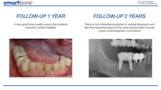Block technique using SmartBone | PPT