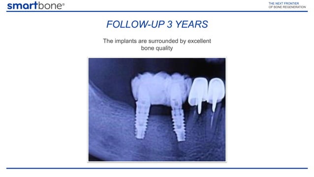 Block technique using SmartBone | PPT