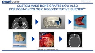 SmartBone: the innovative bone substitute for oral surgery and maxillofacial surgery | PPT