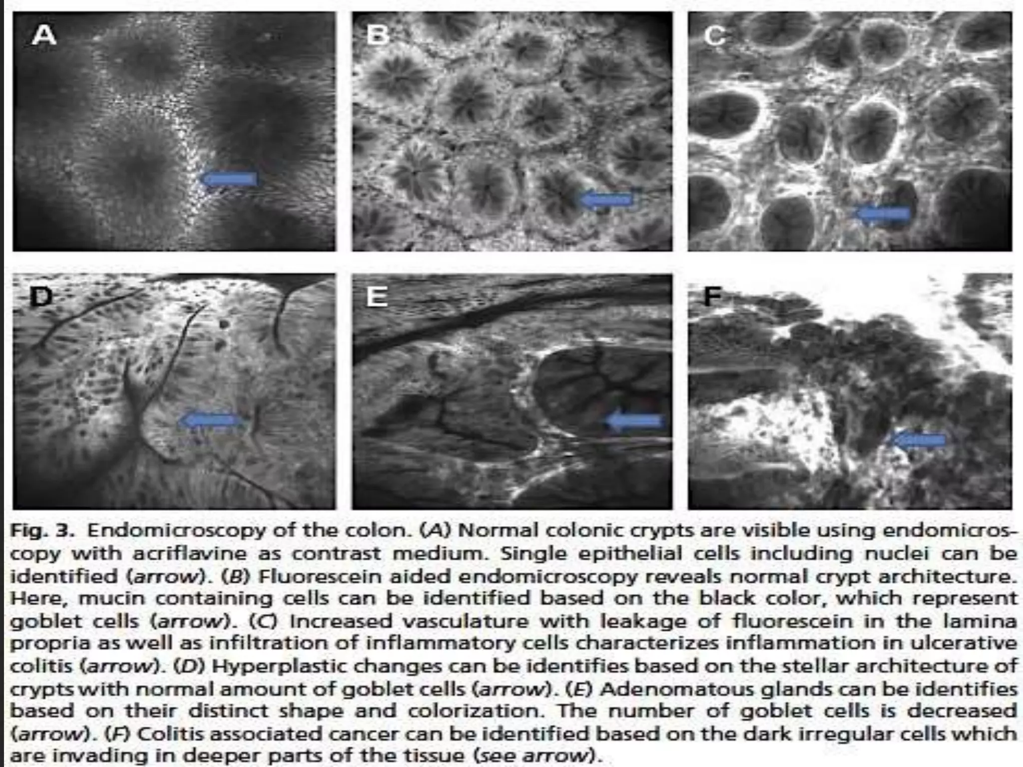 Ulcerative Colitis | PPTX