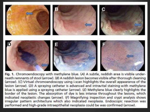 Ulcerative Colitis | PPT
