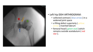 Ibn Sina College L11-Developmental dysplasia Of Hip.pdf