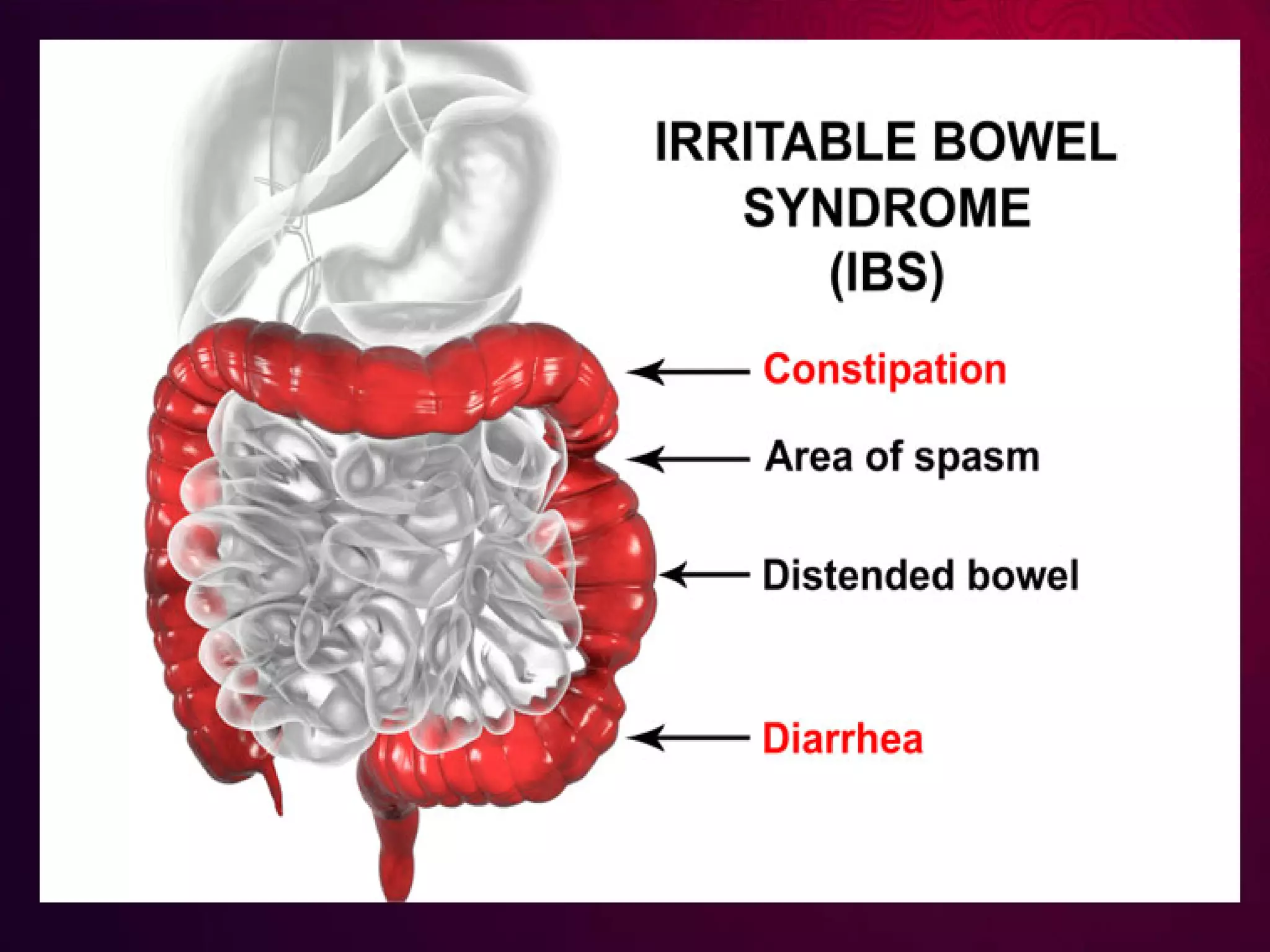Drugs used in the treatment of irritable bowel syndrome (IBS) | PDF