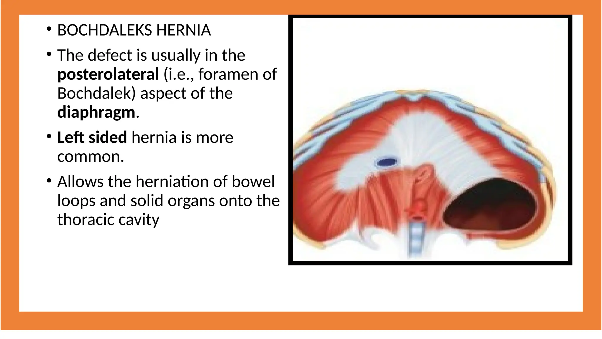 ic- congenital diaphragmatic hernia.pptx
