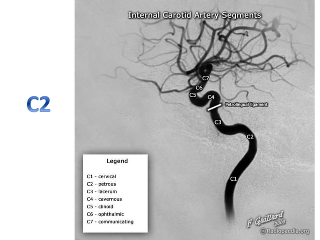 ICA anatomy | PPTX