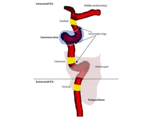 ICA anatomy | PPTX