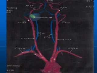 Ica aneurysm | PDF