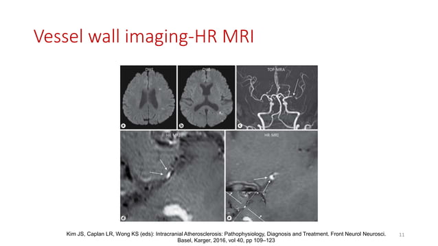 Intracranial atherosclerotic disease | PPTX | Medical Health