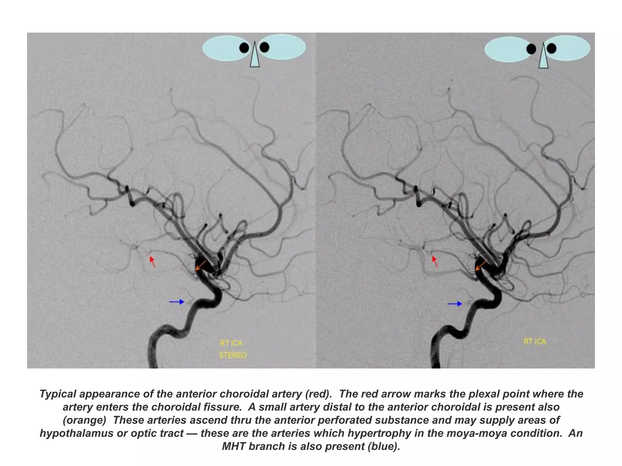 Neuroangio Internal carotid artery and its endovascular aspect | PPTX