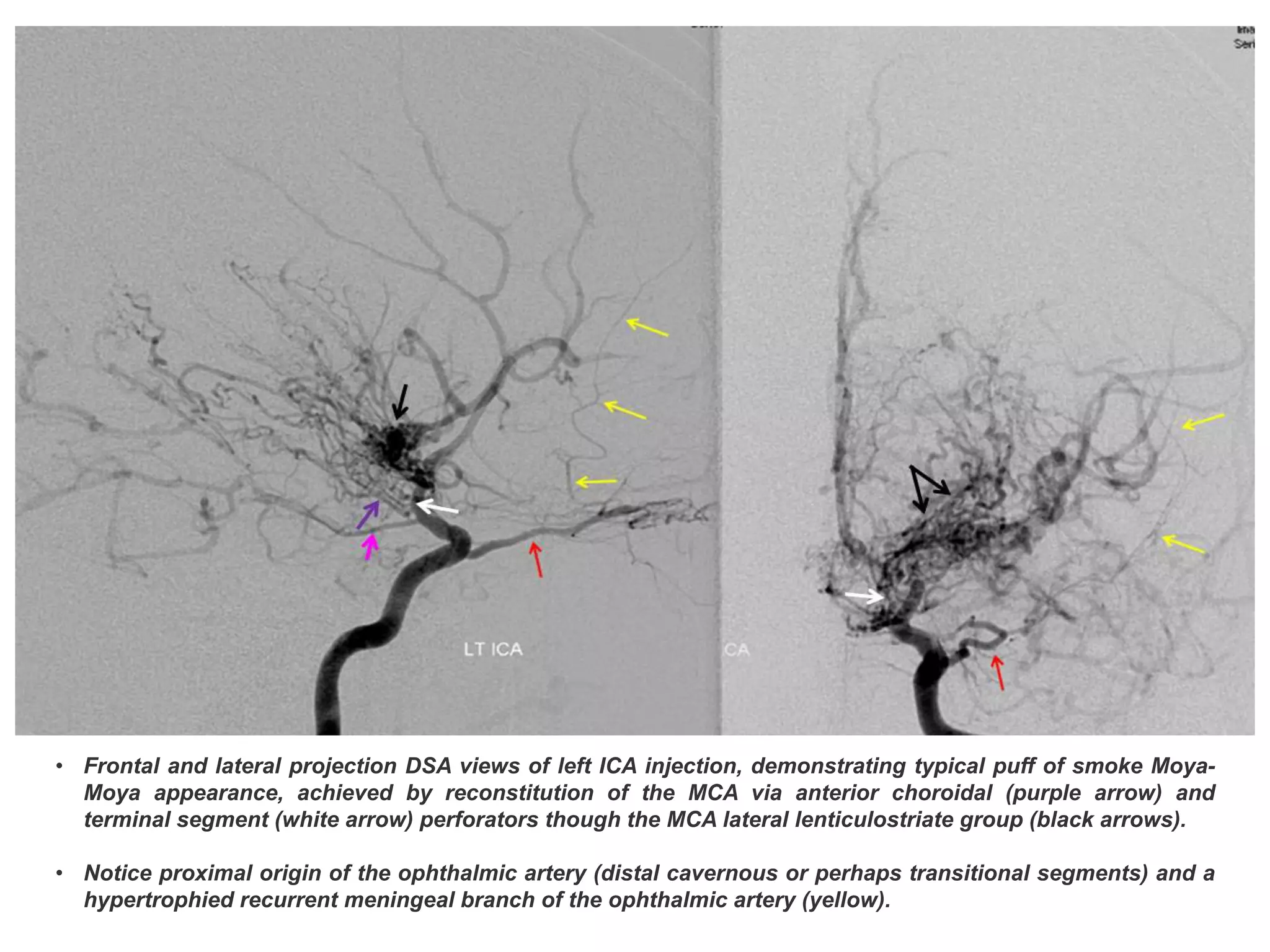 Neuroangio Internal carotid artery and its endovascular aspect | PPTX