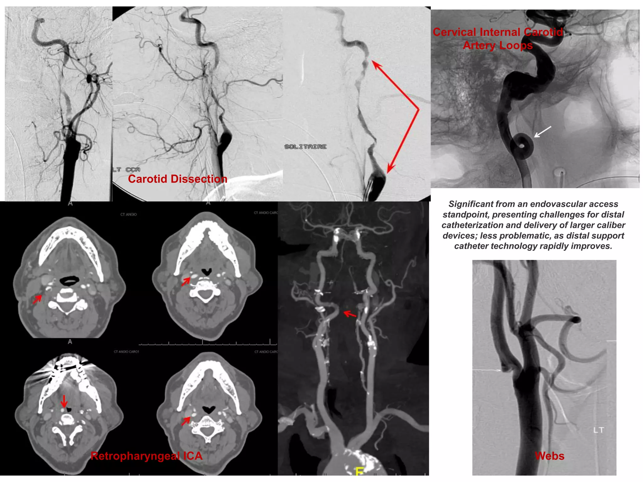 Neuroangio Internal carotid artery and its endovascular aspect | PPTX