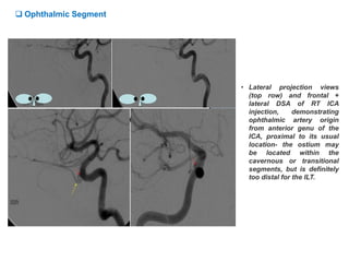 Neuroangio Internal carotid artery and its endovascular aspect | PPTX