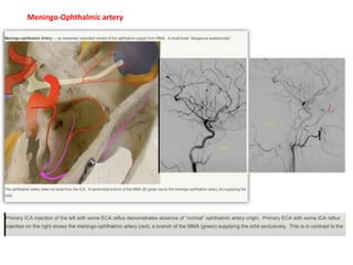 Neuroangio Internal carotid artery and its endovascular aspect | PPTX