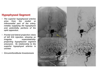 Neuroangio Internal carotid artery and its endovascular aspect | PPTX