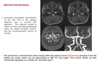 Neuroangio Internal carotid artery and its endovascular aspect | PPTX