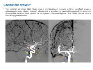 Internal Carotid Artery Angiogram