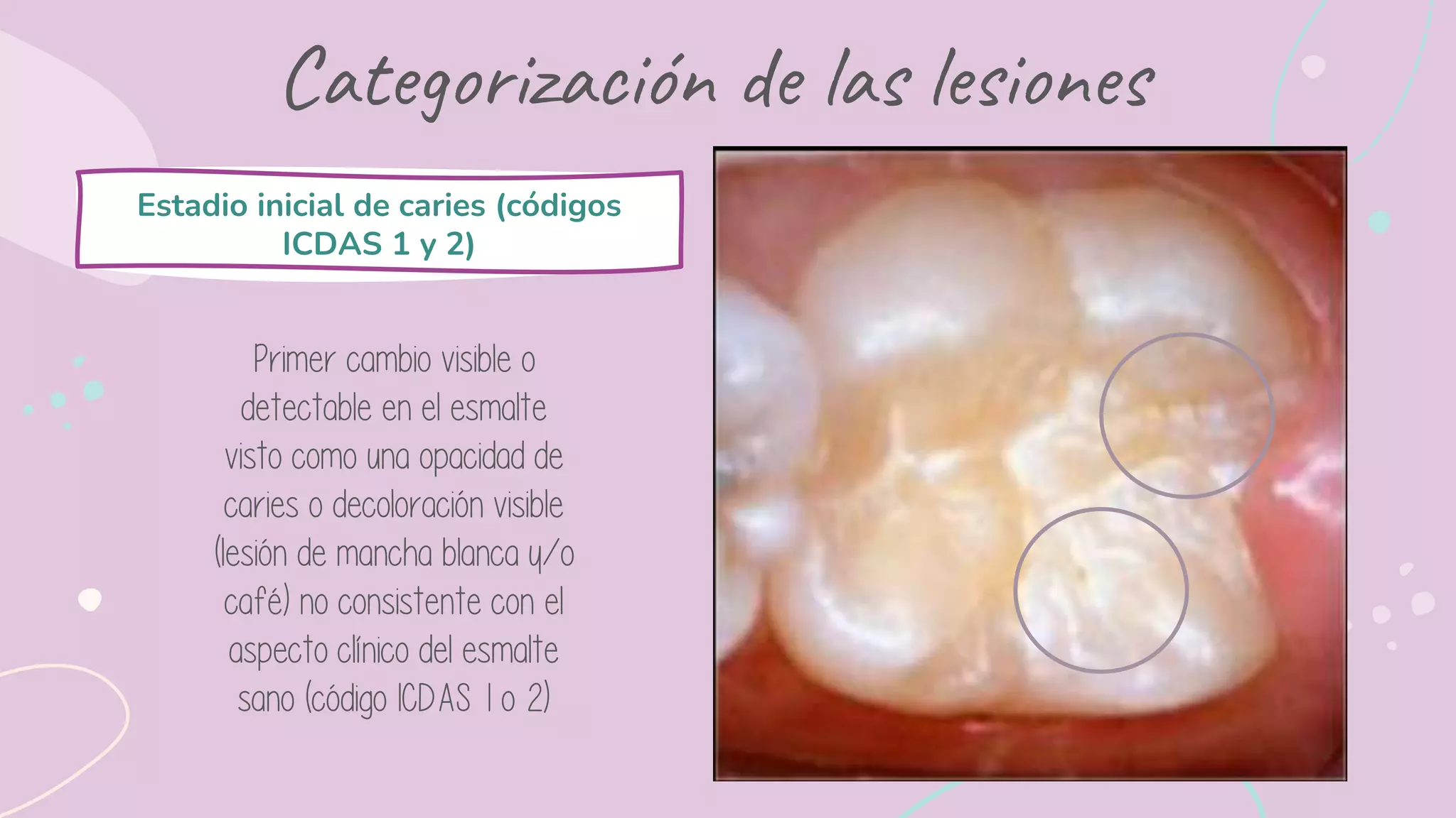 Modificación de detección de caries icdas | PPTX