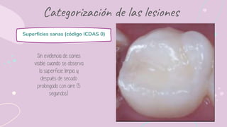 Modificación de detección de caries icdas | PPTX
