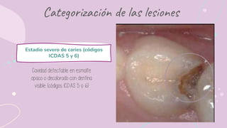 Modificación de detección de caries icdas | PPTX