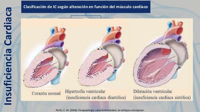 Insuficiencia Cardíaca y Edema Pulmonar Agudo