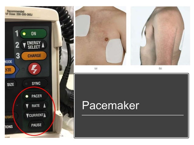 Implantable Cardiac Devices | PPTX